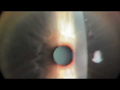 Map Dot Fingerprint Dystrophy