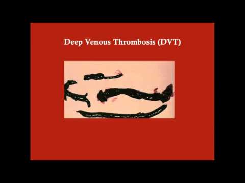 The 5 W's: "Walking" (DVT/PE) - CRASH! Medical Review Series