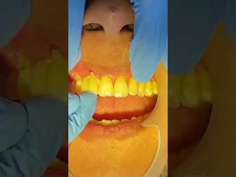 Cantilever Bridge (dental bridge)