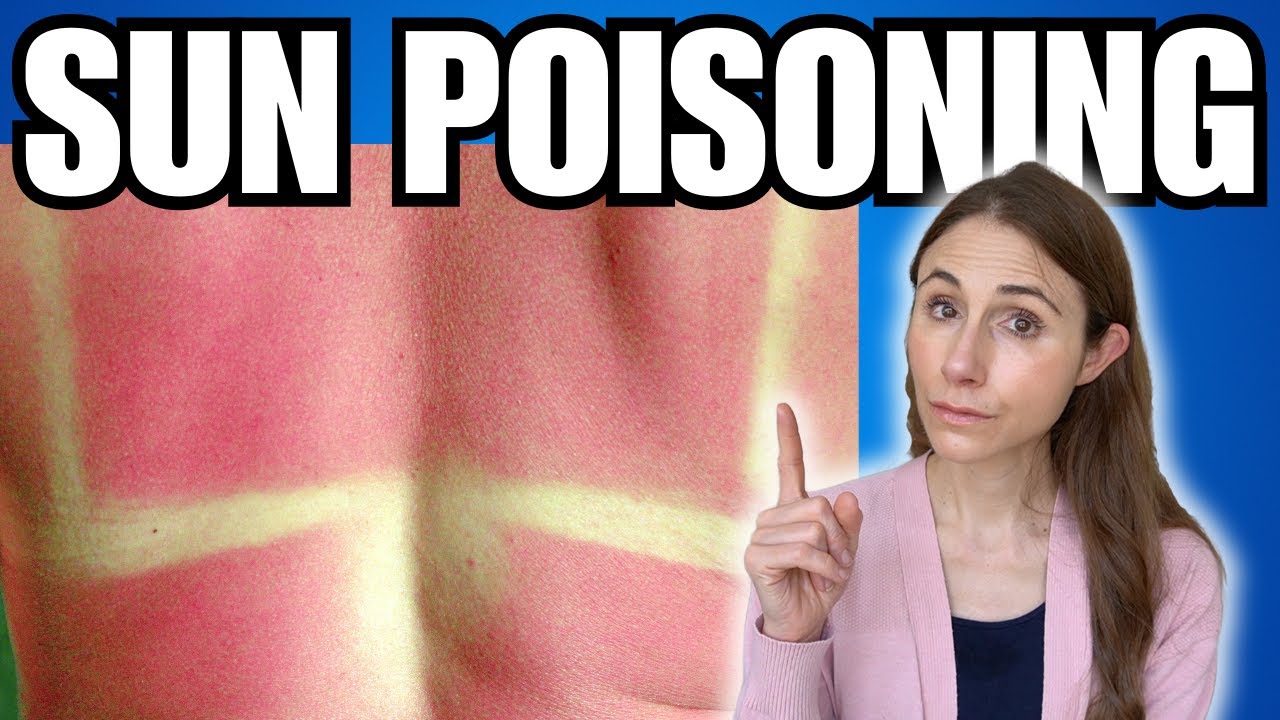 How To Know If You Have Sun Poisoning