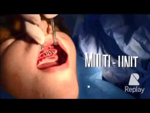 Dr. Tolga Gulcicek Immediate Implant Placement & Immediate loading