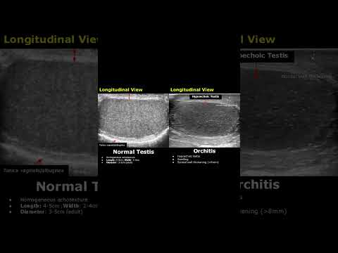 Orchitis Ultrasound Features | Scrotal Scan Normal Vs Abnormal | Testis USG #shorts