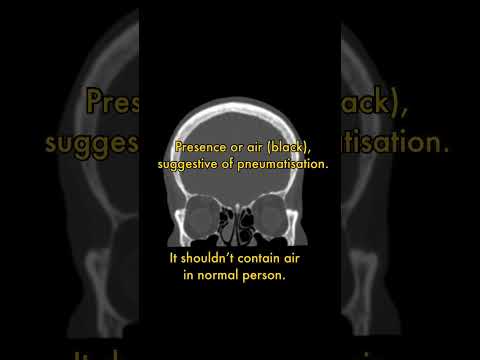 Concha bullosa (normal variant) on CT brain #radiology #medicine #anatomy #ctscan
