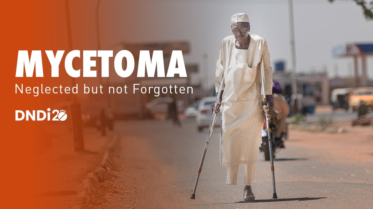 Mycetoma: Neglected but not Forgotten