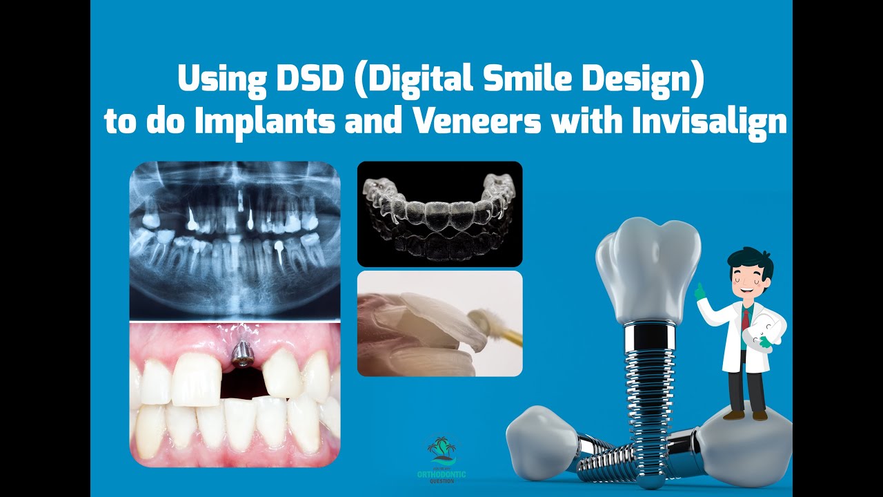 Digital Smile Design (DSD) and Invisalign for Veneers and Implants