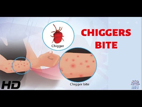 CHIGGERS BITE: Everything You Need To Know