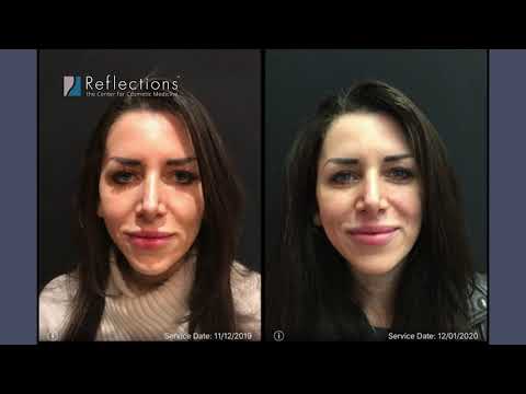 My Story: I Didn't Realize I Had Botched Fillers Until I Came to Reflections Center