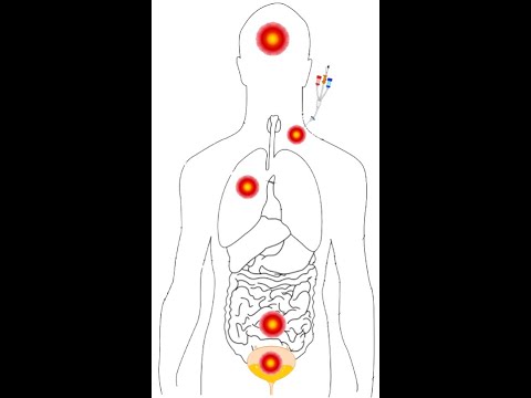 Empirical Antibiotic Use Overview_algorithms for ESBL, CRE, MDR and XDR