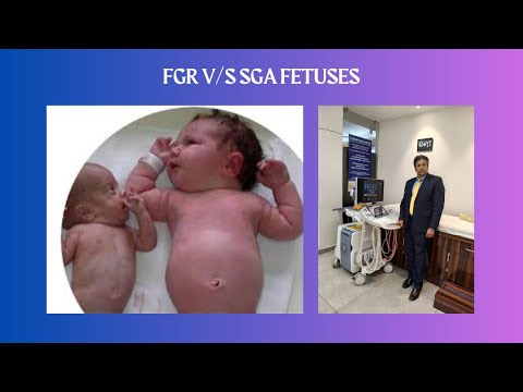 FGR v/s SGA fetuses