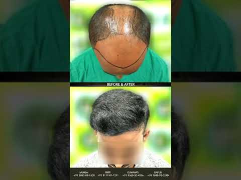 Hair Transplant in Bhubaneswar | Hair transplant cost | Bhubaneswar hair loss clinic