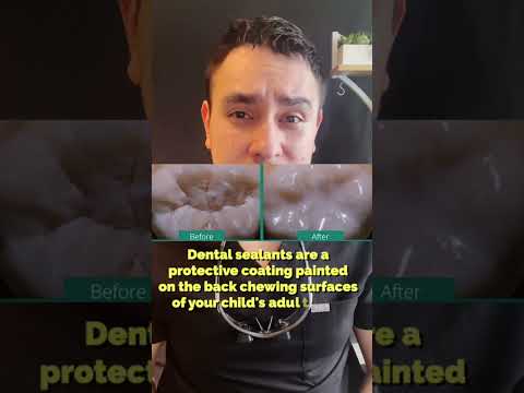 Dental Sealants for Kids?