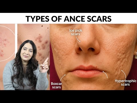 Pimples - Treatment of acne pits | Types of Acne Scar Treatment | Acne Scar Treatment Hindi