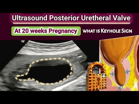 Obstetrical Ultrasound - Posterior Uretheral Valve at 20 week Pregnancy