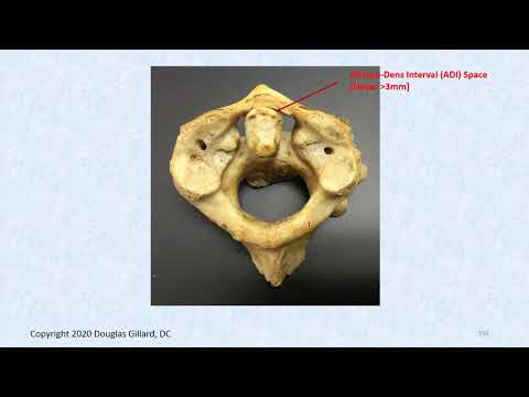 Upper Cervical Spine Anatomy: (Part 1): Finish Atlas Anatomy and a quick look at ligaments.