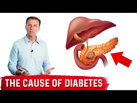 Your Fatty Pancreas Caused Your Diabetes