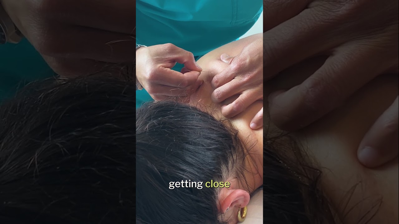 Treating Common UPPER BACK PAIN with Acupuncture! PART 2