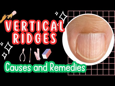 Understanding Vertical Lines on Nails, Main Causes and their Remedies