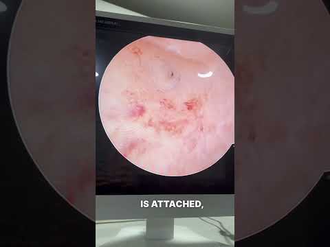 Removing Uterine Polyps: What to Expect?#drsuniljindal#bestivf #uterus #baby #polyp #removal #cavity