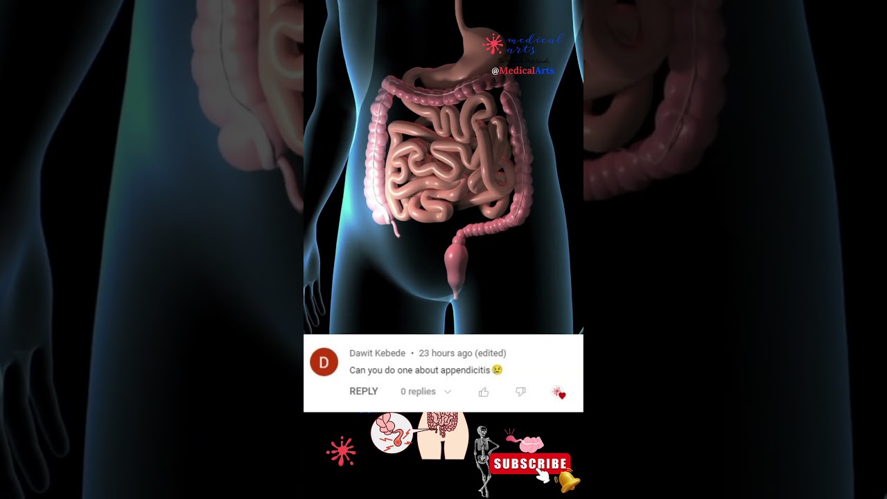 Appendicitis [] Appendix Location [] Appendicitis symptoms