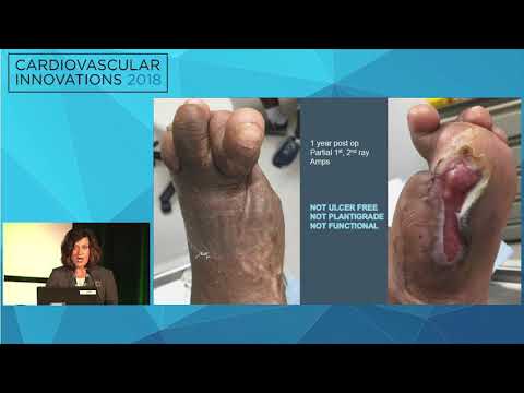 CVI2018 Session: What is a functional amputation - Georgeanne Botek, DPM