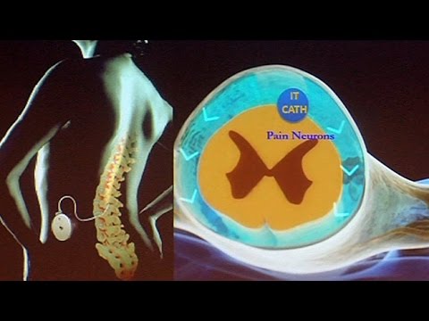 Technology Versus Pain