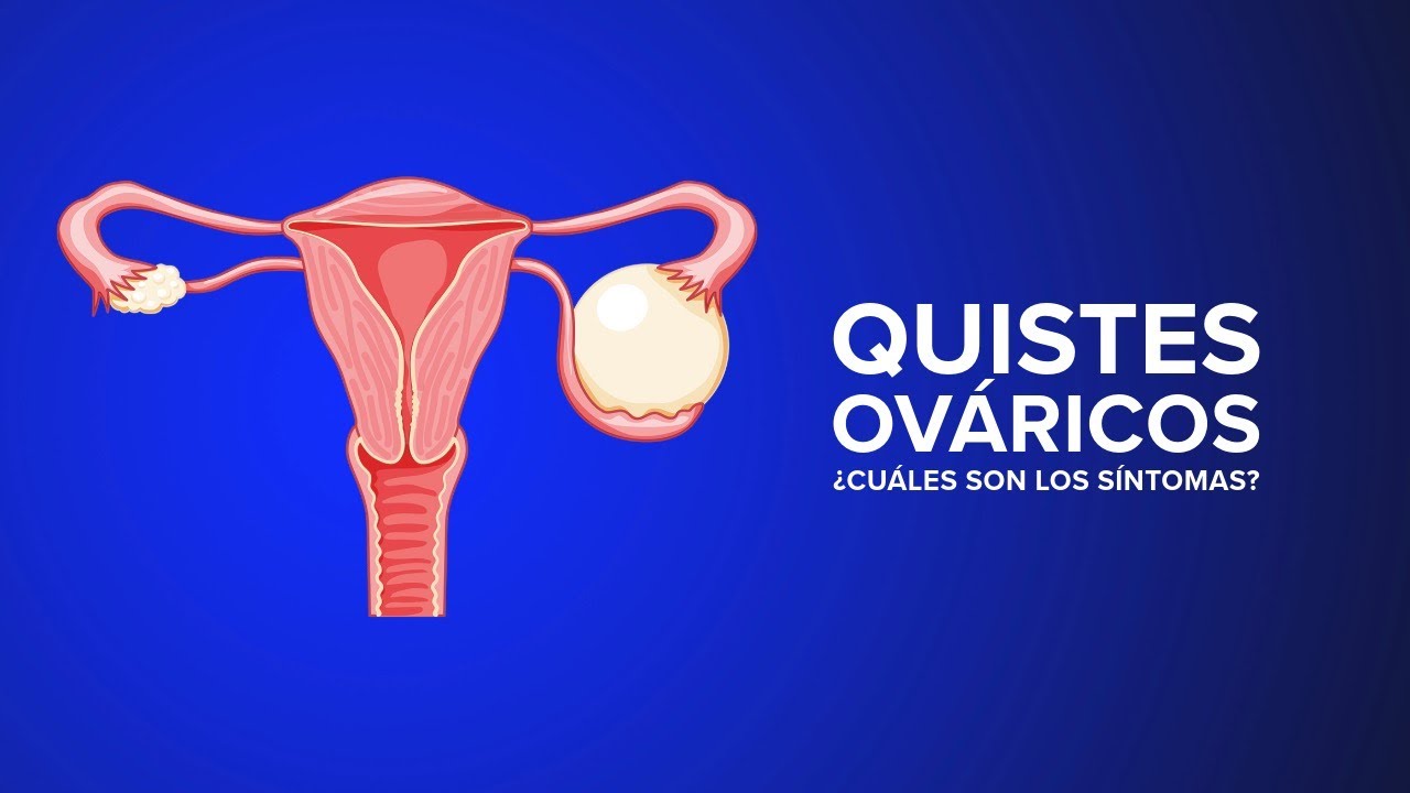 Quistes de ovario: ¿Cuáles son los síntomas?