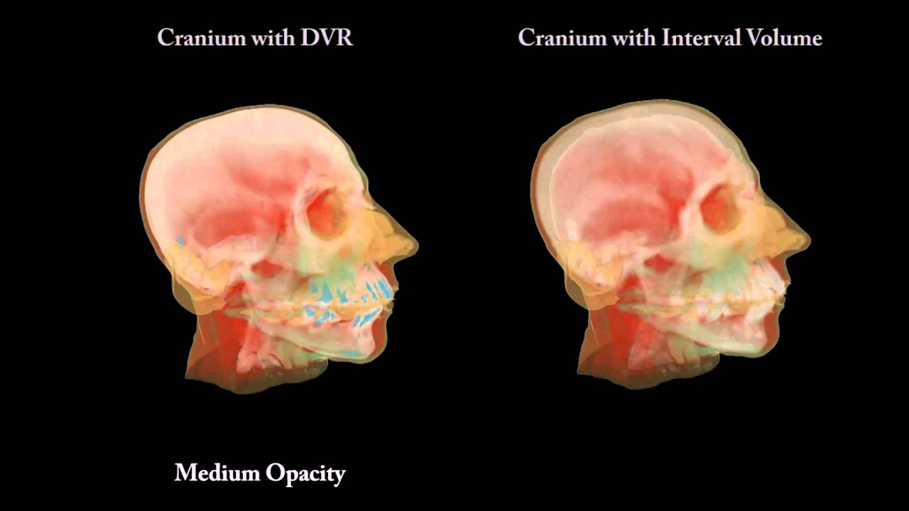 Direct Interval Volume Visualization