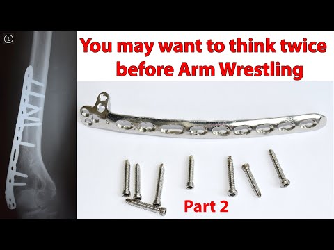 Titanium Bone Plates - Titanium Bone Reconstruction Plates Latest Price ...