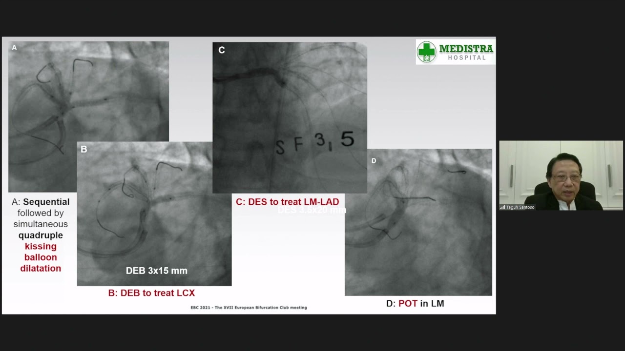 LM quadrifurcation - Dr Teguh SANTOSO