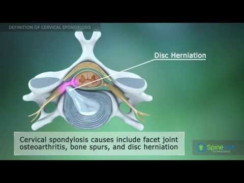 Cervical Spondylosis. Definition