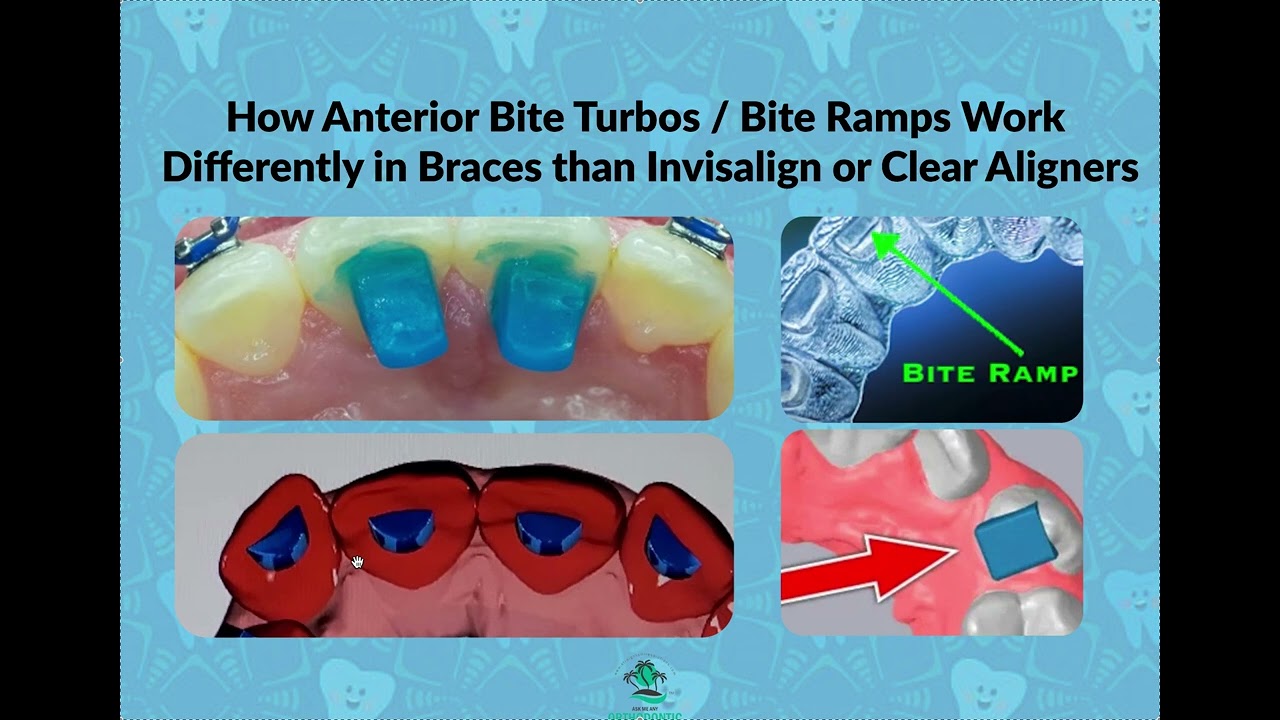 How do Anterior Bite Turbos work Differently in Braces or Clear / Invisalign Aligners?