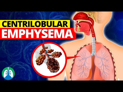 Centrilobular Emphysema (Medical Definition) | Quick Explainer Video
