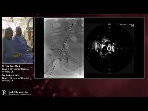 Stenting unilateral chronic disease on right hand side - Chapter 5