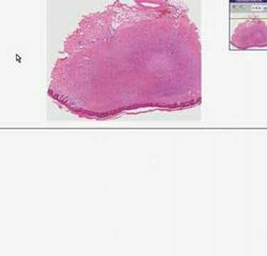 Histopathology Skin--Dermatofibroma