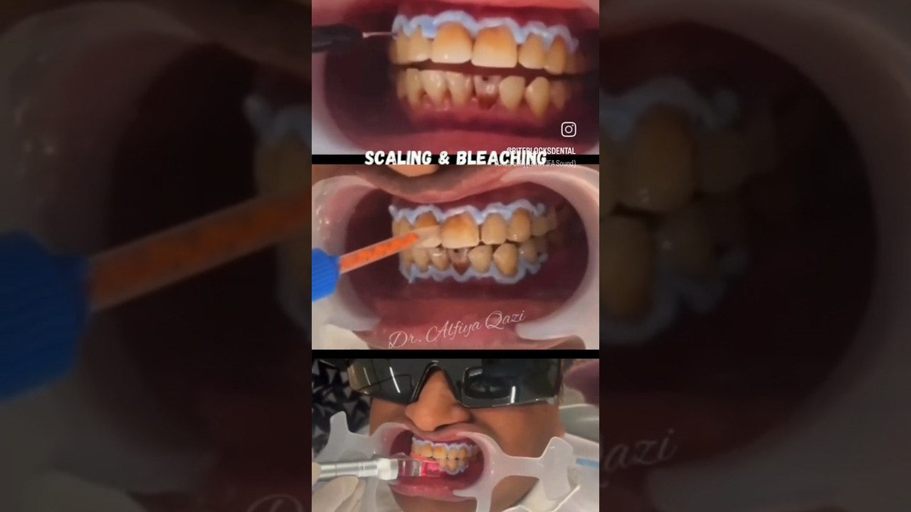 Unbelievable Smile Transformation: From Dull to Dazzling in Just One Visit! 😁✨