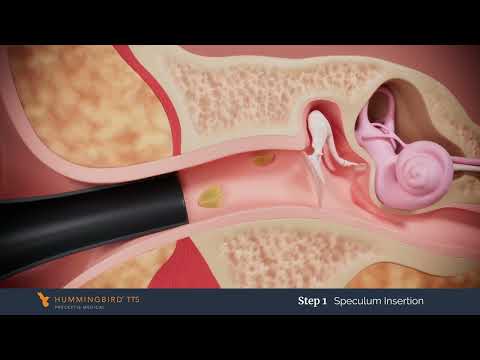 Hummingbird Procedure Video: One-Pass® Technology