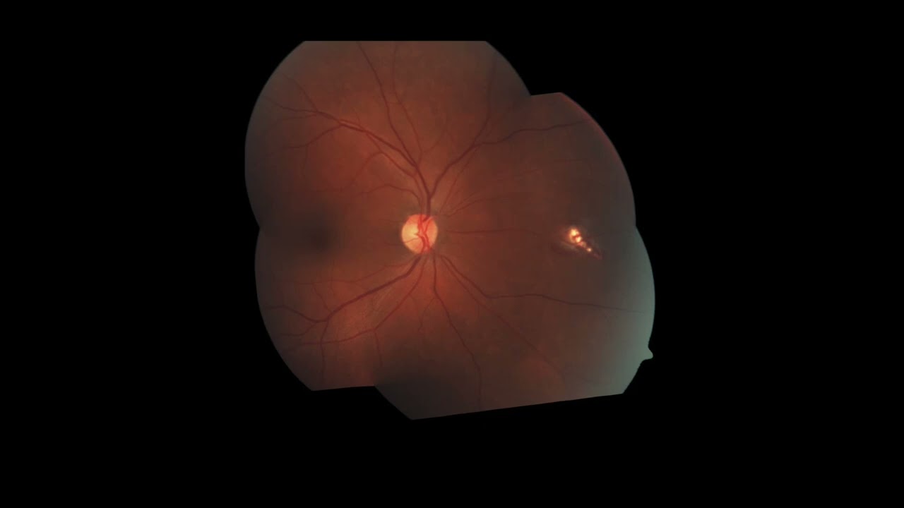 retina tip 2 - choroidal rupture