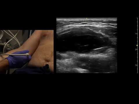 Ultrasound of the Vascular Structures in the Antecubital Fossa