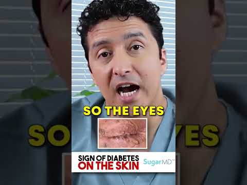Skin Tags | Sign of Diabetes on The Skin