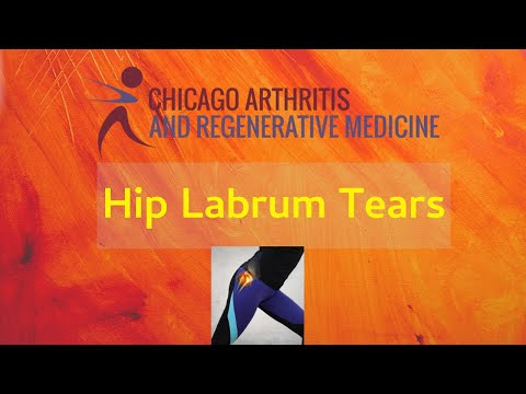 Hip Labral tear
