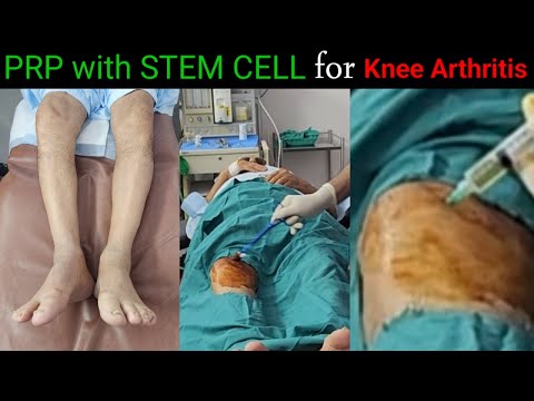 PRP Injection together with Stem Cell Therapy for knee arthritis / R 3 Stem Cell