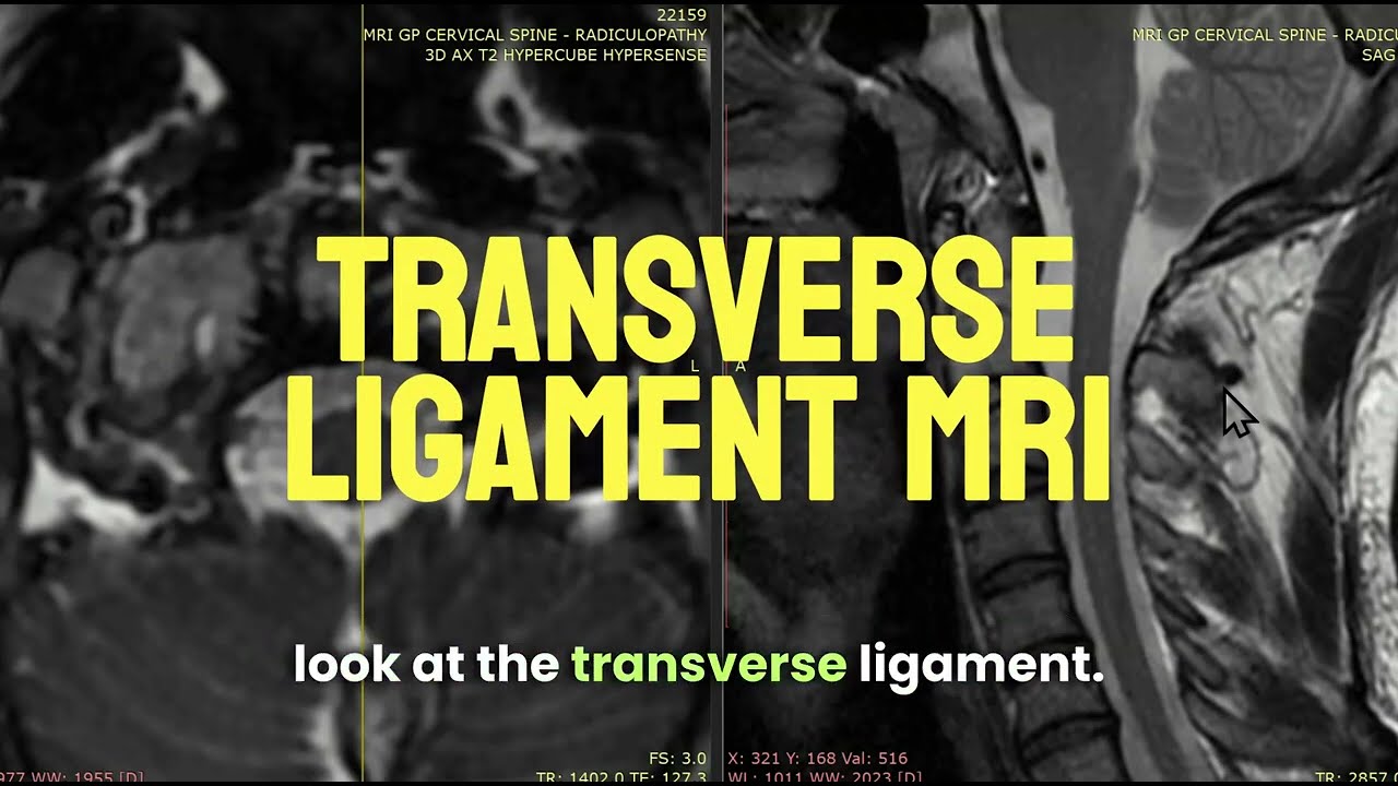 Transverse Ligament Imaging for CCI
