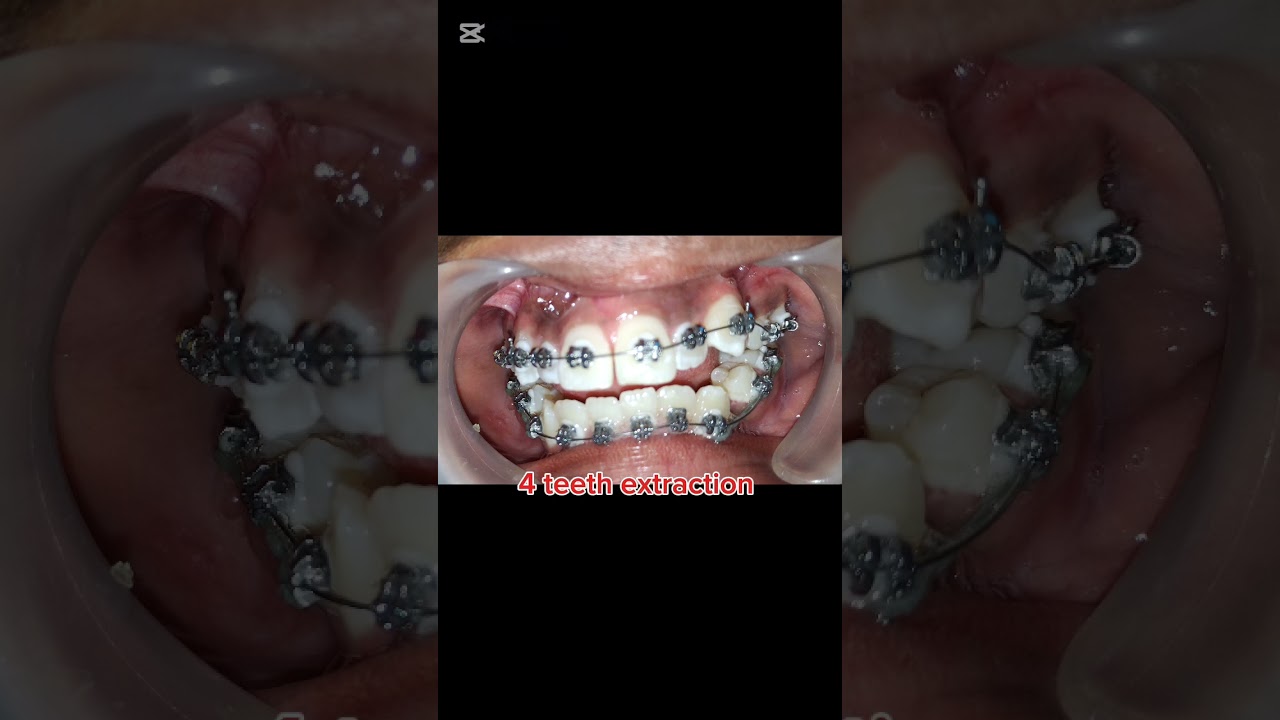 Have You Ever Used Self Ligating Braces #braces #dentalbraces #orthodontistbraces