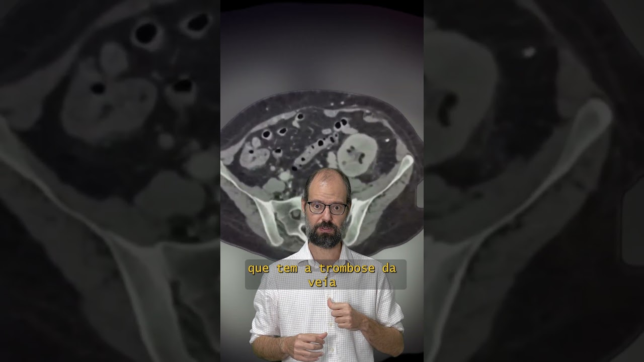 Hot Spot Sign: an important sign in radiology.