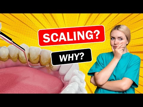 What is DENTAL SCALING? And Why You Need IT?
