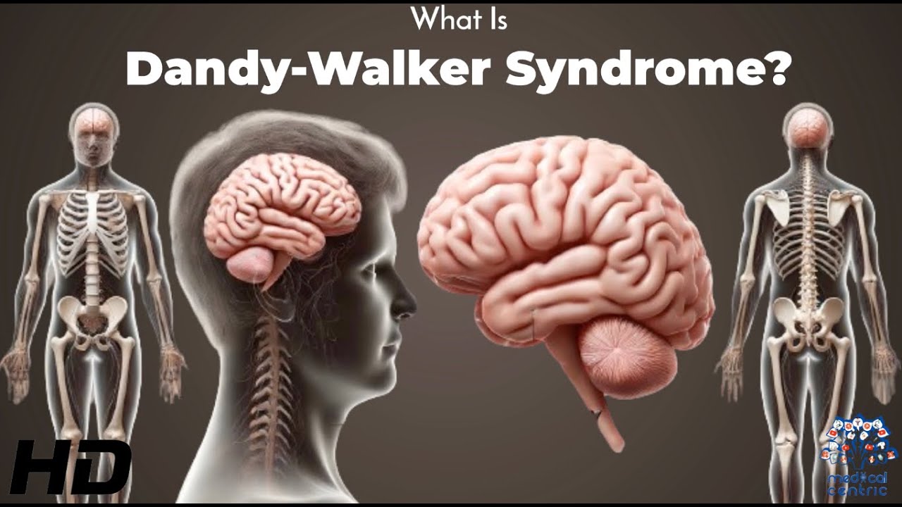 Dandy Walker Syndrome: An In-Depth Overview