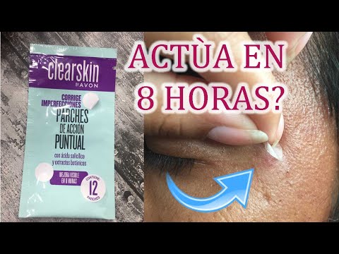 Lo que necesitas saber sobre los parches para el acné