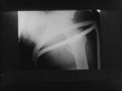 Use of a Thomas Bed Knee Splint (1938)