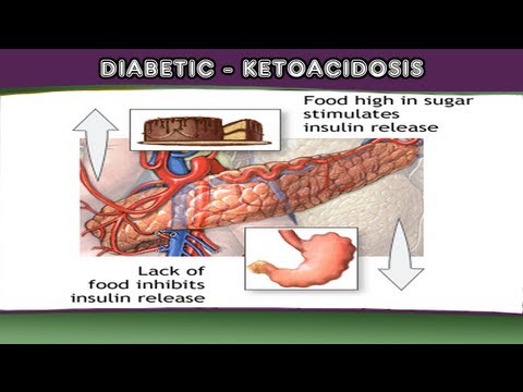 Proper E code for Diabetic with Ketoacidosis