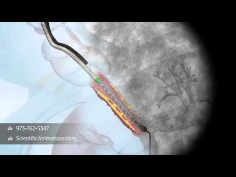 Surgical Stent at Best Price in India